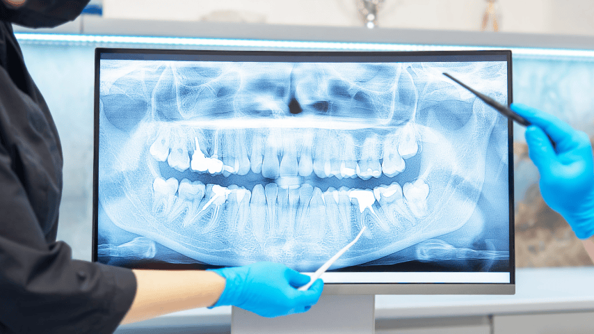 Apicoectomy Surgery: Complete Guide for Patients